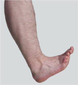 Legg/ankel/fot – BevApp