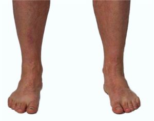 Legg/ankel/fot – BevApp