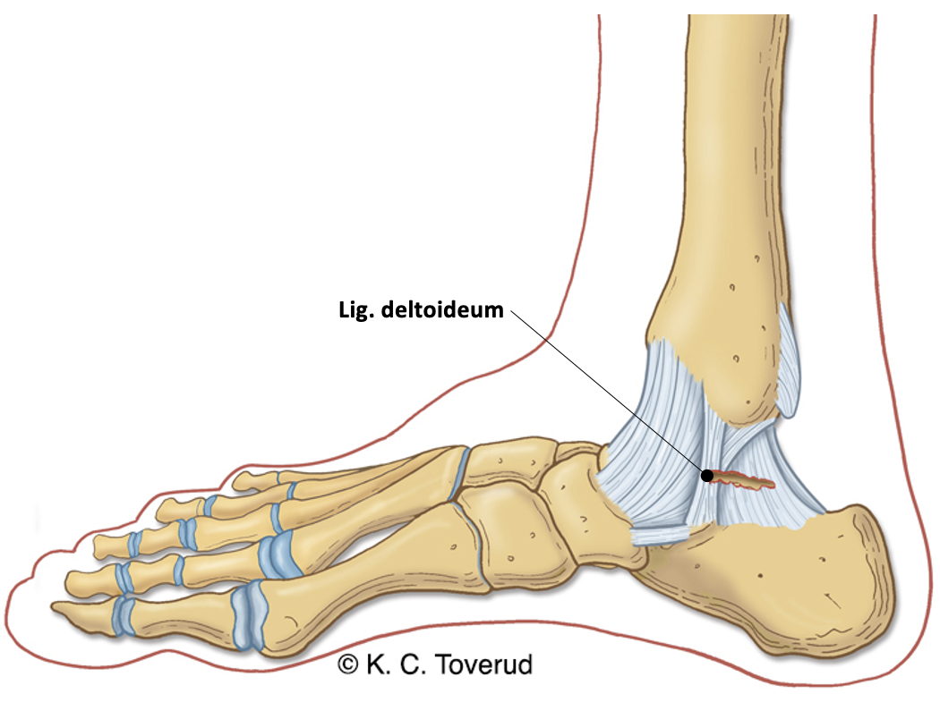 Ligamentskade ankel – BevApp