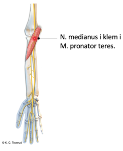 M. pronator teres syndrom – BevApp