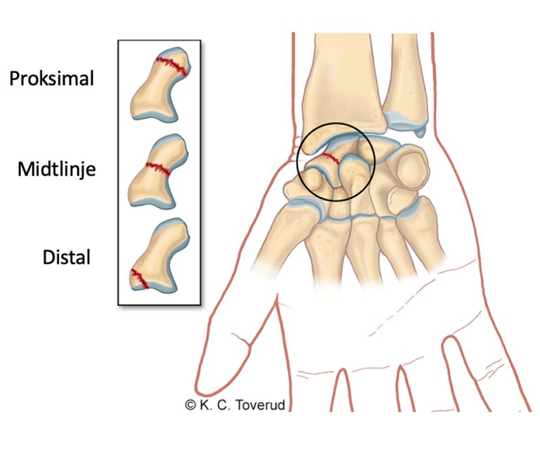 Scafoidfraktur – BevApp