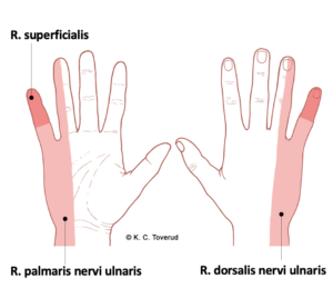Ulnar tunell syndrom – BevApp